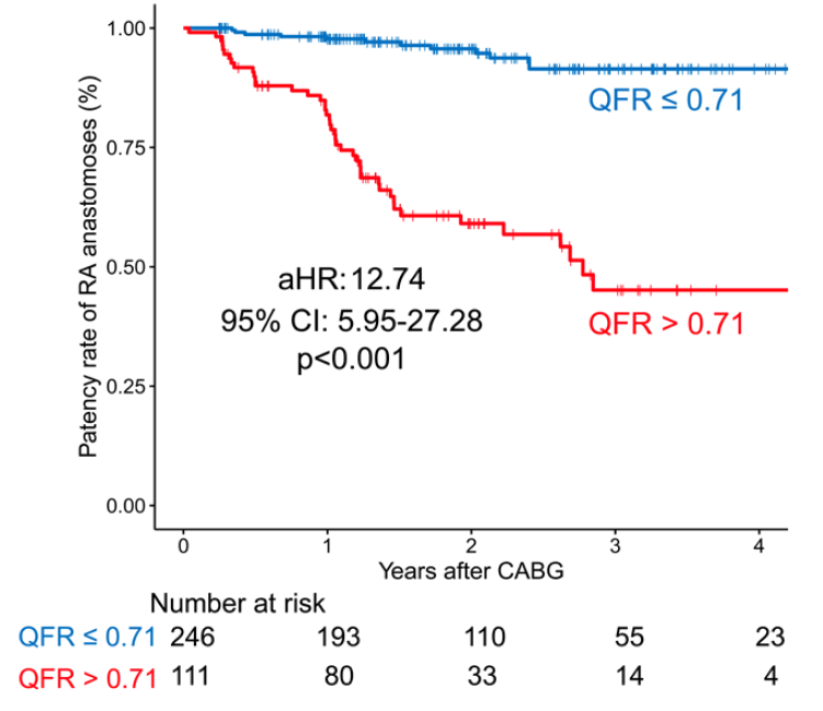 心血管顶刊 Circulation 发布阜外最新研究：博动 QFR® 作为桡动脉桥血管选择新标准！ - 博动医疗