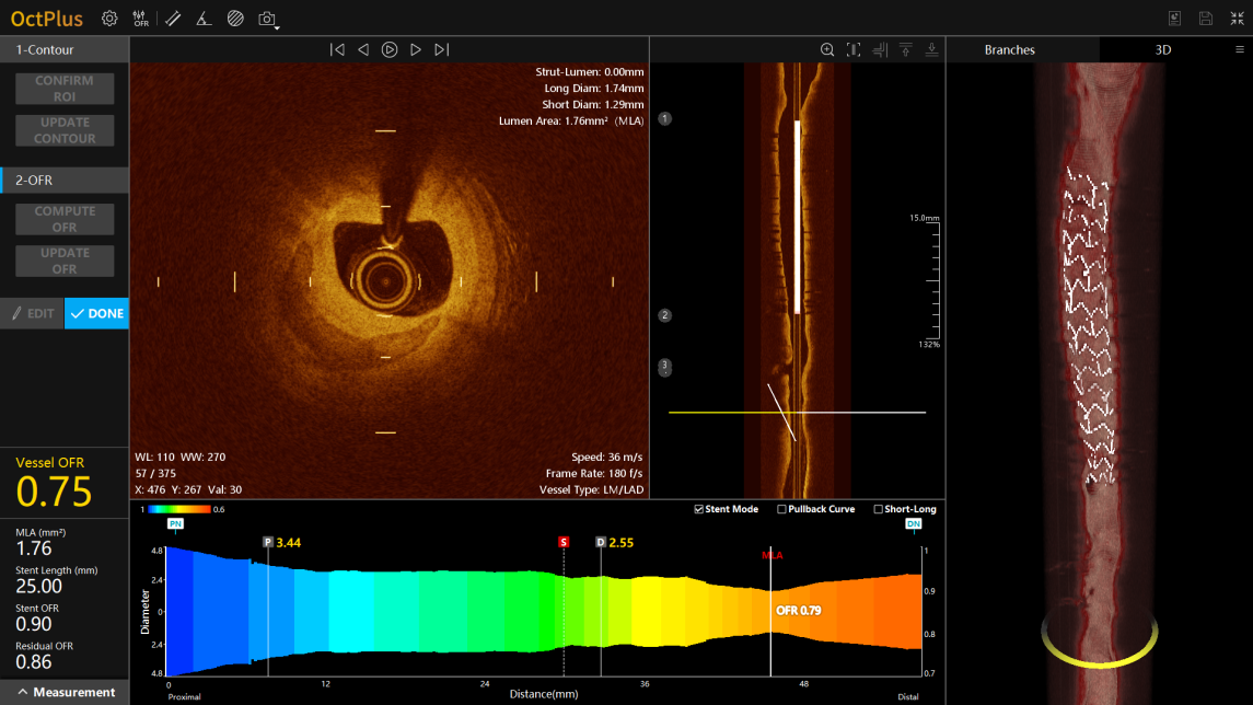 重磅！OFR获CE认证！成为全球首个获批的基于OCT的FFR评估技术 - 博动医疗