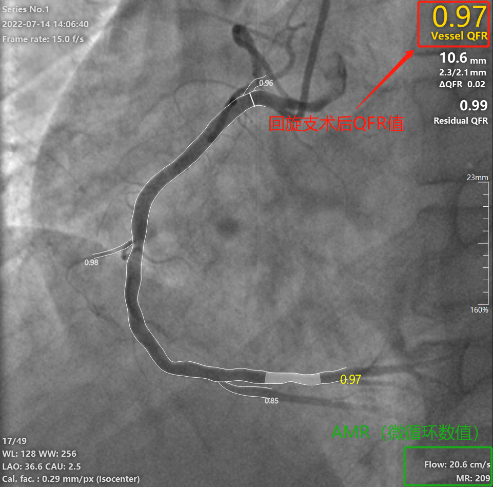 优势技术 | 我院心血管内科采取无创功能学QFR新技术精准指导冠脉介入手术 - 博动医疗