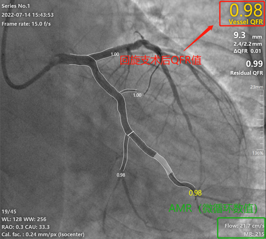 优势技术 | 我院心血管内科采取无创功能学QFR新技术精准指导冠脉介入手术 - 博动医疗