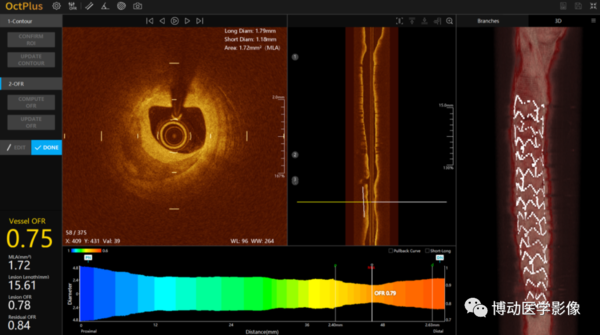 学术|EuroIntervention：基于AI的OCT虚拟组织学功能获得国际心脏介入治疗领域认可 - 博动医疗