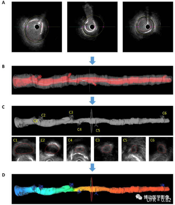 学术|Circulation介入子刊: 全球首个基于IVUS的FFR技术UFR诊断精度完成国际临床验证 - 博动医疗