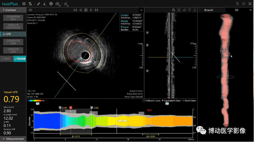 学术|Circulation介入子刊: 全球首个基于IVUS的FFR技术UFR诊断精度完成国际临床验证 - 博动医疗