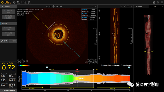 中国原创冠脉OFR获批三类证！全球首个基于OCT的影像FFR产品在国内上市 - 博动医疗