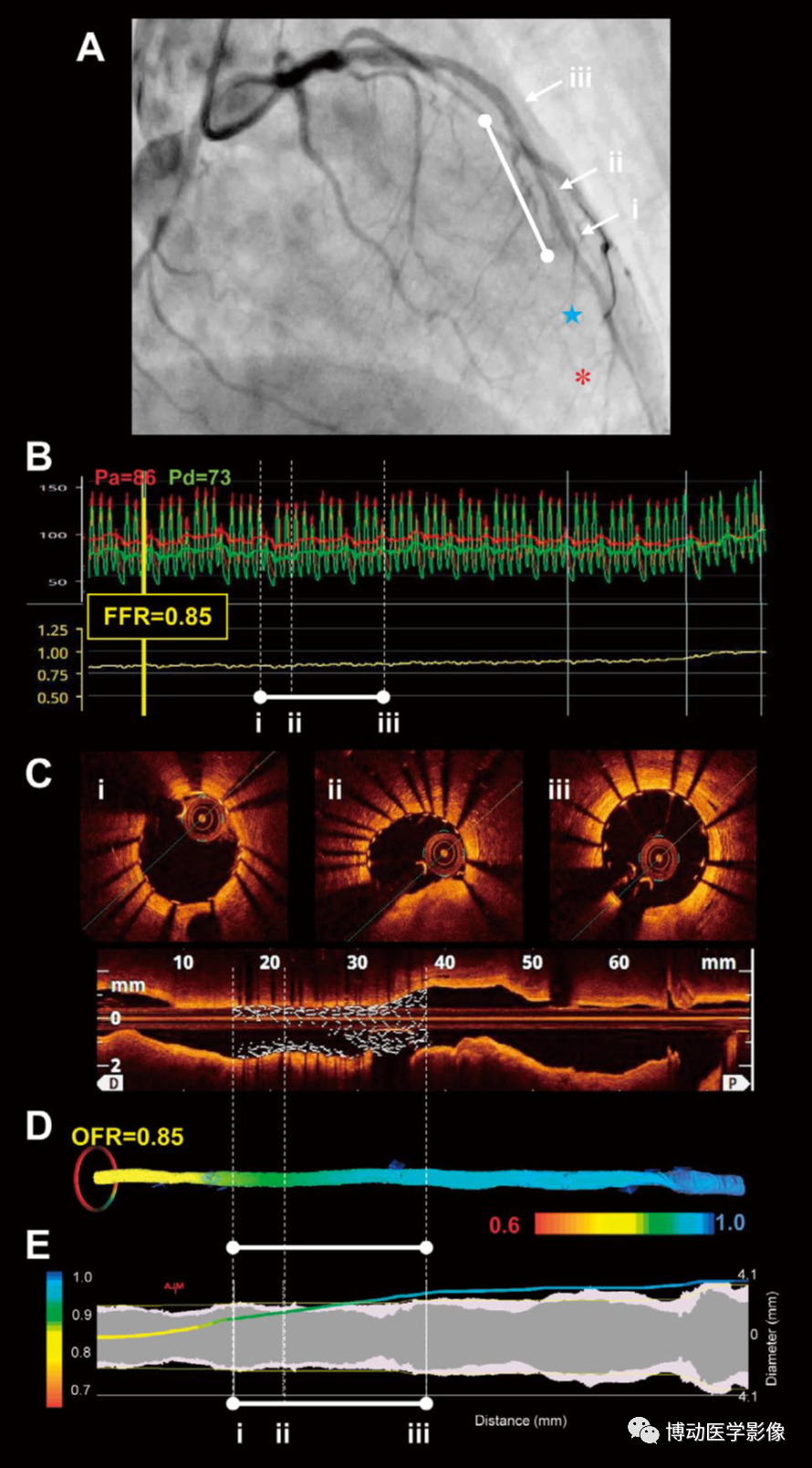 学术 | 最新证据：PCI术后即刻OFR与FFR具有高度相关性和良好的一致性 - 博动医疗