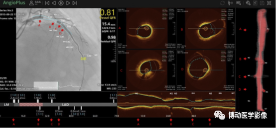 JACC子刊丨中国原创OCT与造影的智能配准技术，将大幅提升OCT临床使用便利度 - 博动医疗