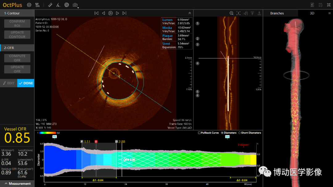 学术丨EuroIntervention：OFR（OCT-FFR）评价支架置入效果及残余病变的生理意义 - 博动医疗