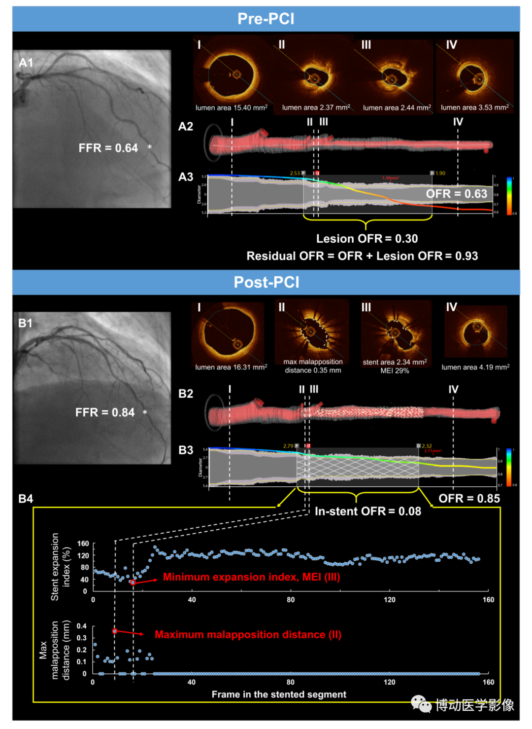 学术丨EuroIntervention：OFR（OCT-FFR）评价支架置入效果及残余病变的生理意义 - 博动医疗