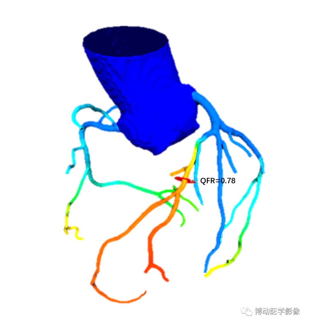 首发丨博动冠脉CT-QFR获欧盟CE认证，博动泛血管精准诊断赛道4款创新产品全面上市 - 博动医疗